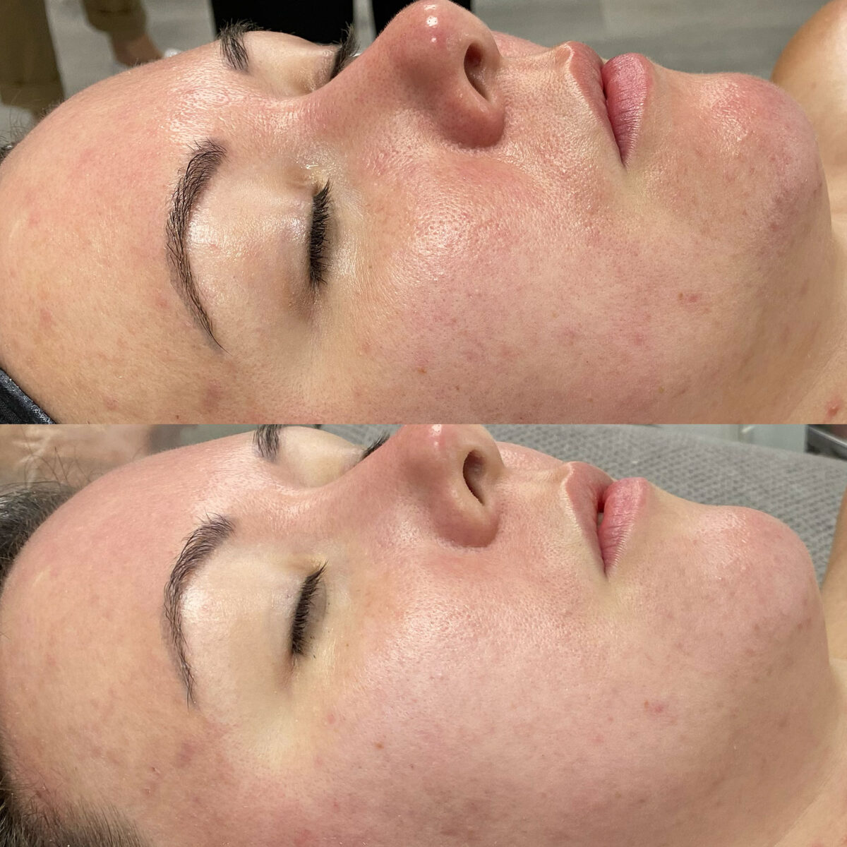 Pro Dermal Spa Peels - Evolve Beauty Electrolysis